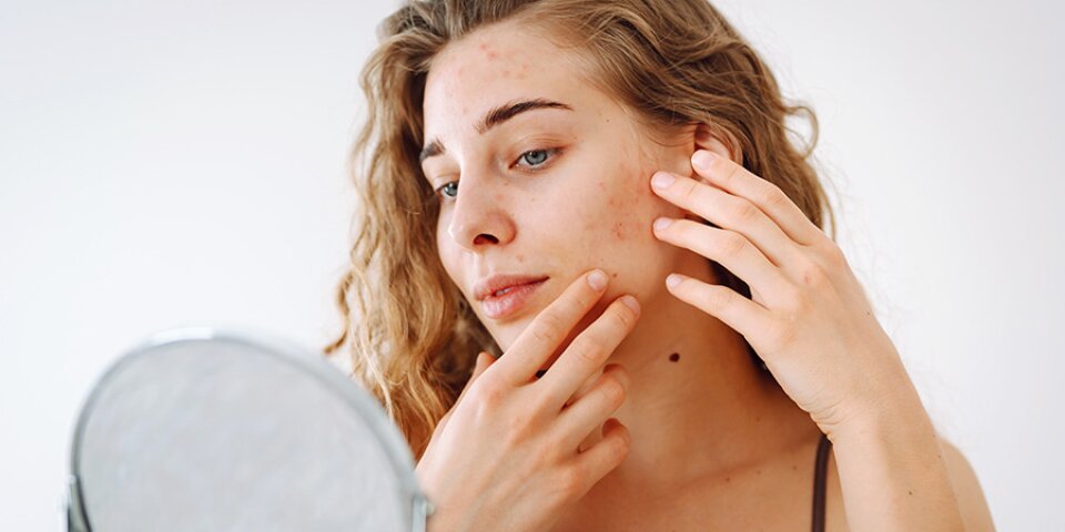 Acne: natuurlijke oplossingen voor een gekalmeerde huid | Newpharma ...